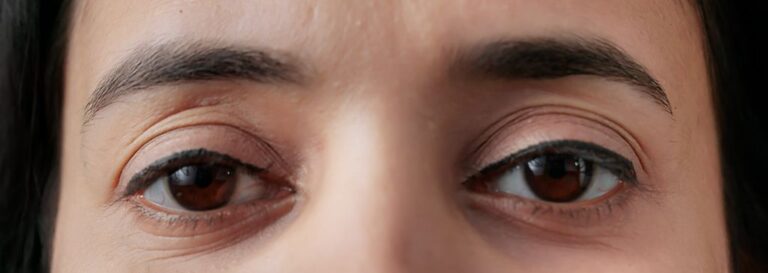 What Are the Stages of Open Angle Glaucoma? – Bagan Winkels Vision